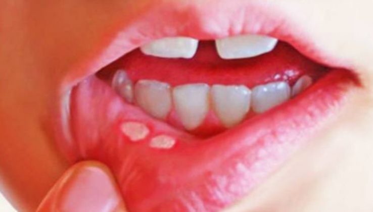 Afte alla bocca: come lenire il dolore e non soffrirne più