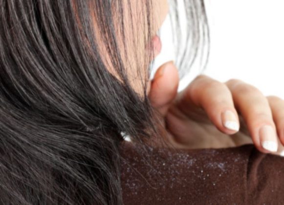 Forfora: 2 rimedi naturali per eliminarla e non sentirsi più a disagio