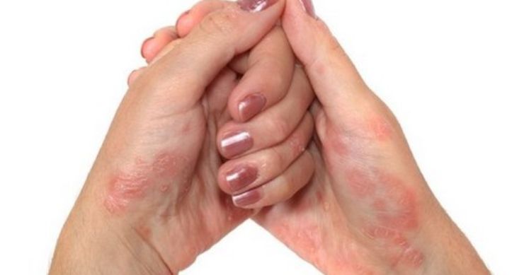Come combattere la psoriasi: 4 efficaci rimedi naturali