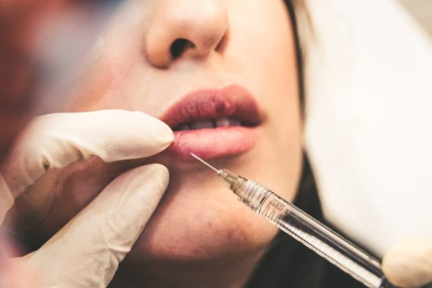 Filler alle labbra: cos'è e come funziona il trattamento