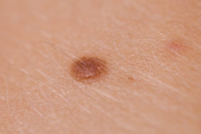 Eliminare i peli dei nei: come fare, i consigli e i metodi migliori