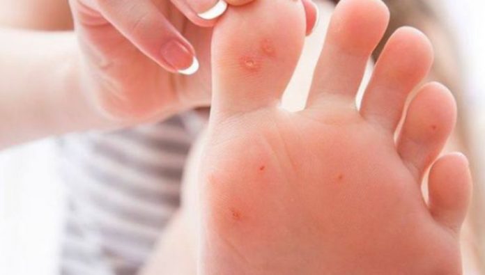 Verruche: da cosa sono causate come si combattono