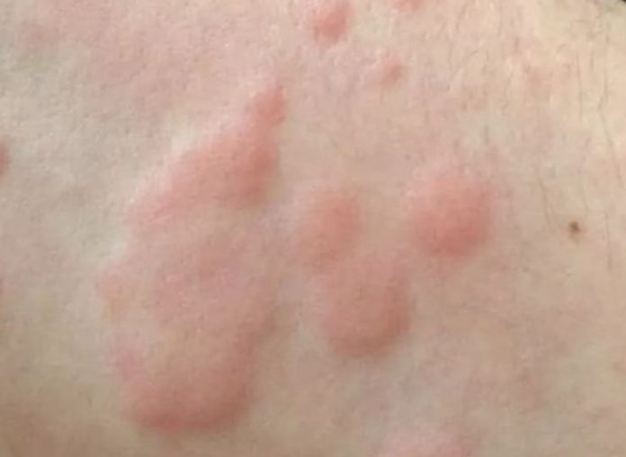 Orticaria: quali sono i sintomi, le cause e i rimedi più efficaci Orticaria: quali sono i sintomi, le cause e i rimedi più efficaci