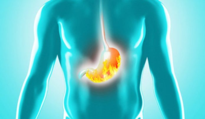 Esofagite da reflusso: cause e sintomi di questo disturbo