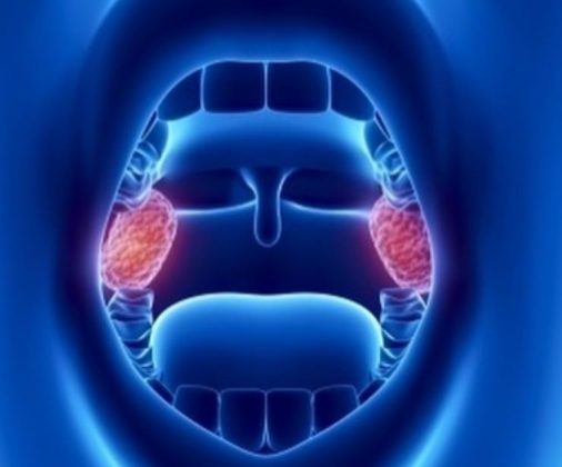 Tonsille sempre ingrossate: ecco il motivo e come intervenire