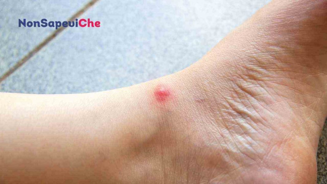 L'unico rimedio alla puntura d'insetto è questo - NonSapeviChe