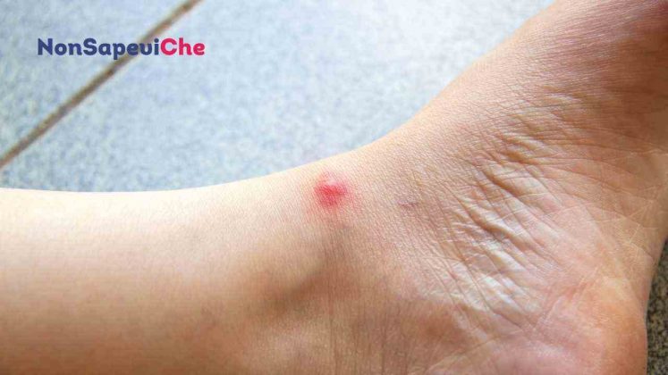 L'unico rimedio alla puntura d'insetto è questo - NonSapeviChe