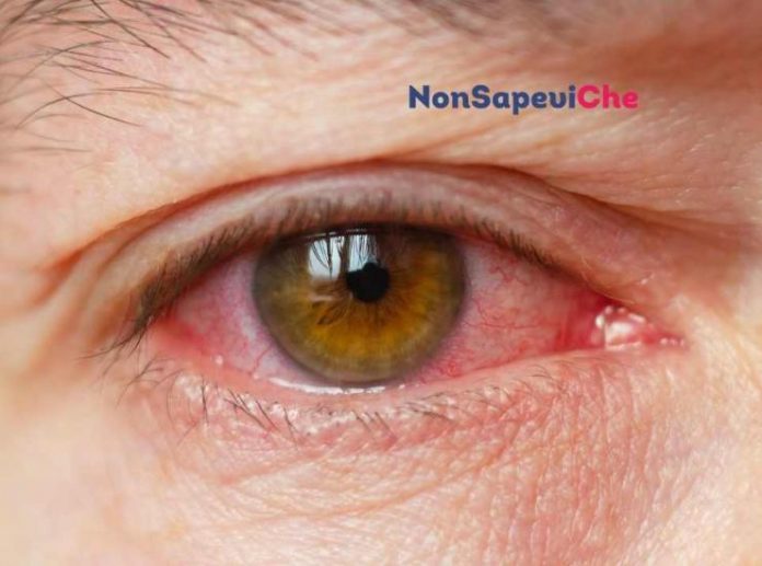 Congiuntivite, e se fosse altro? Come riconoscerla: i sintomi ...