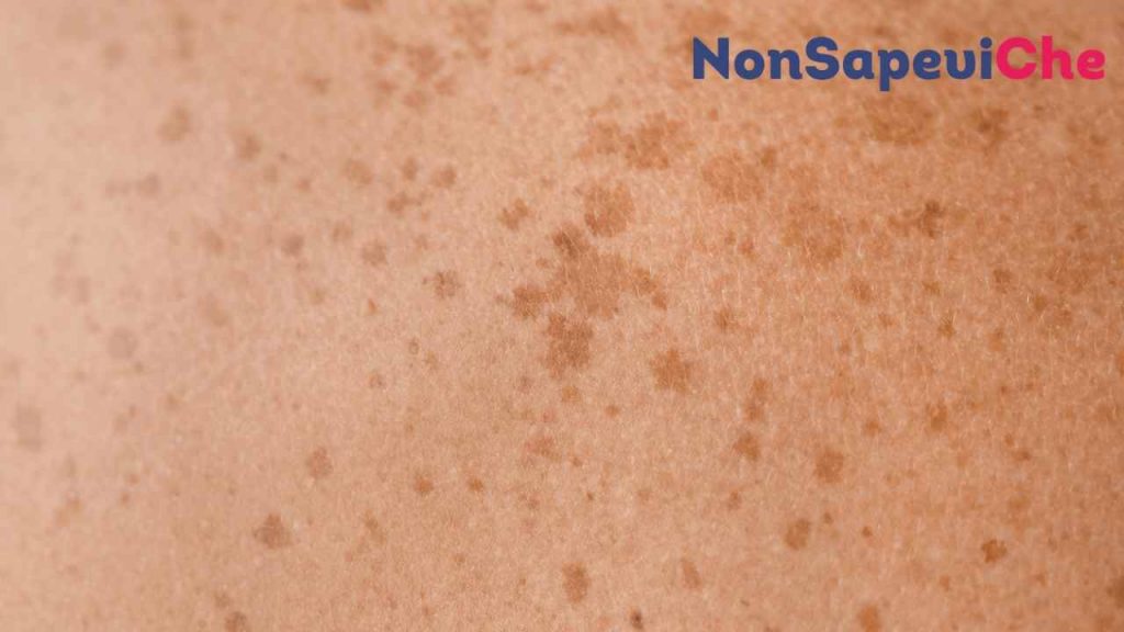 Hai le lentiggini o le efelidi, ecco la risposta al tuo dubbio ...